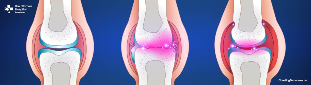 Tout sur la polyarthrite rhumatoïde | L’Hôpital d’Ottawa