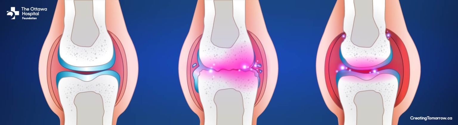 Tout sur la polyarthrite rhumatoïde | L’Hôpital d’Ottawa