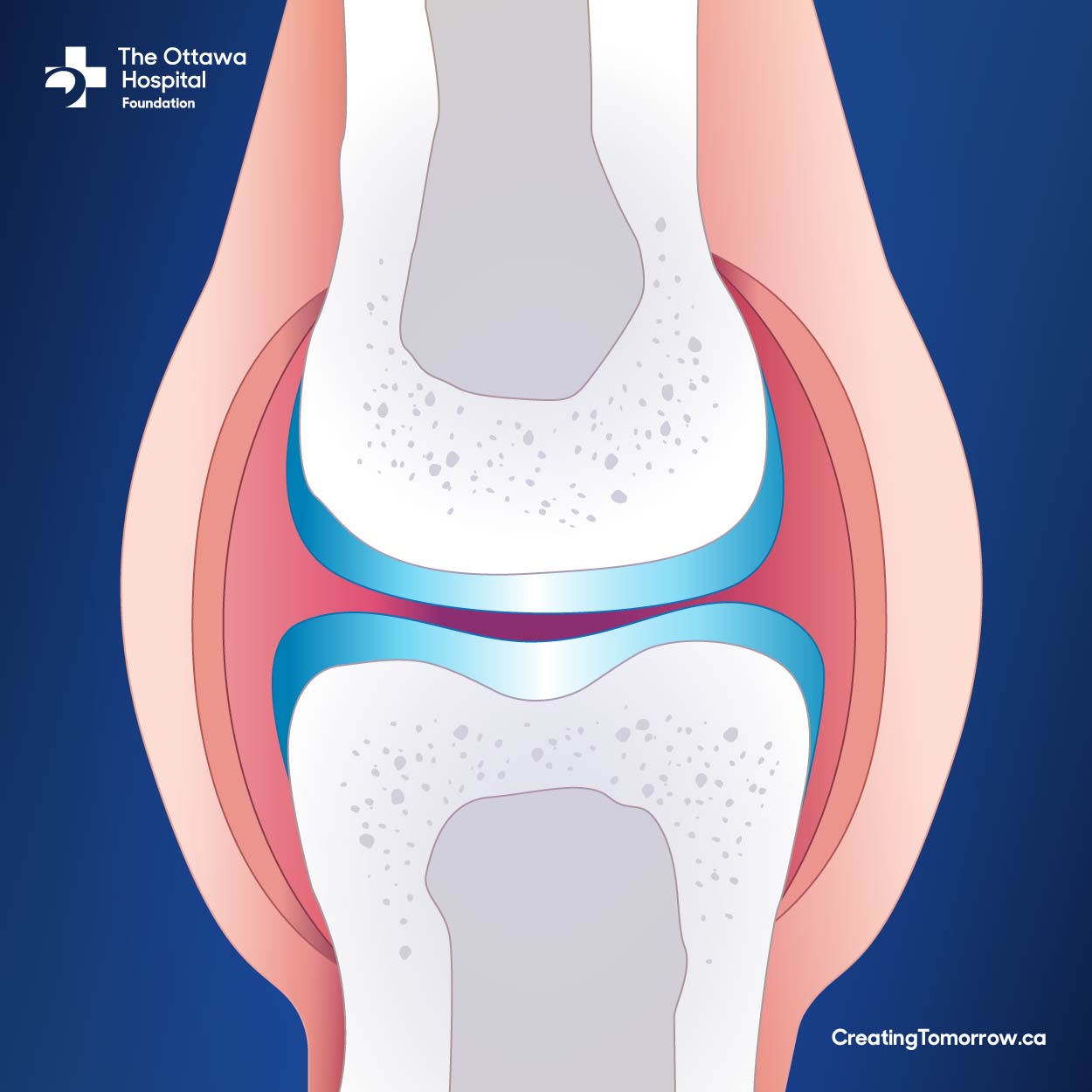 Tout sur la polyarthrite rhumatoïde | L’Hôpital d’Ottawa