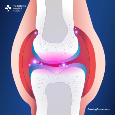 Tout sur la polyarthrite rhumatoïde | L’Hôpital d’Ottawa