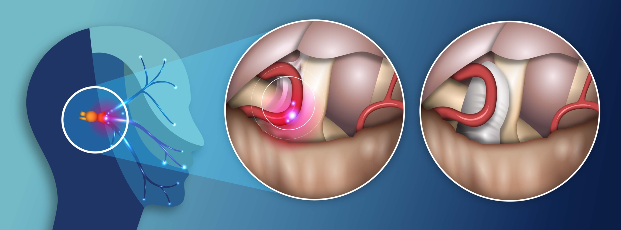 Tout sur la névralgie du trijumeau | L’Hôpital d’Ottawa